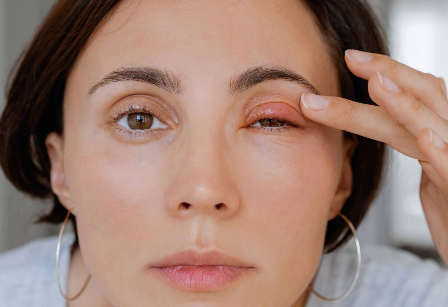 Hoe kom je van een ooglid ontsteking af? - Santé